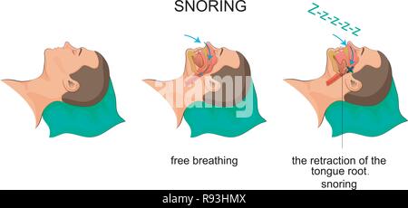 Anatomy of human airway while snoring Stock Vector Image & Art - Alamy