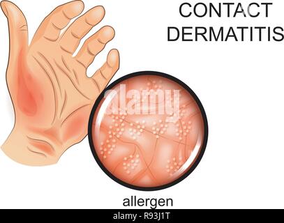 vector illustration of contact dermatitis. Allergy, dermatology Stock ...
