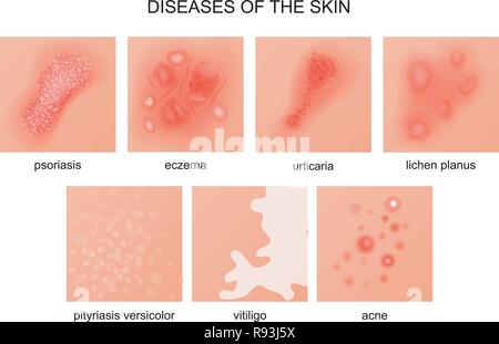 Skin diseases. Derma infection, eczema and psoriasis. Dermatology ...