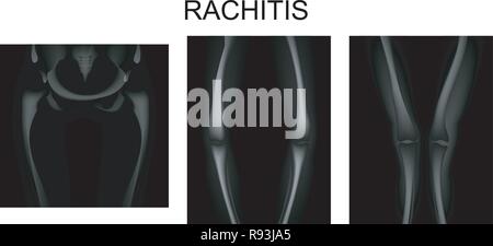 A vector illustration of the anatomy of a child with rickets symptoms ...