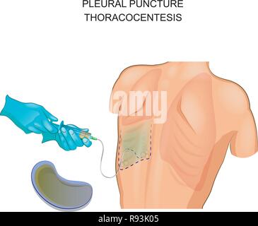 vector illustration of air embolism blood vessel Stock Vector Image ...
