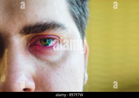 Human eye upper eyelid chalazion before and after side by side ...