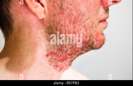 Man with seborrheic dermatitis in the beard area Stock Photo - Alamy