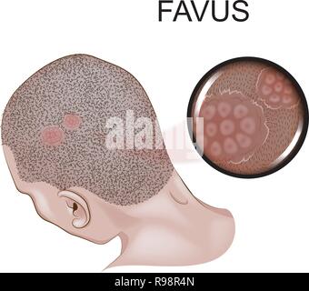 vector illustration of the favus. fungal infection of the skin Stock ...