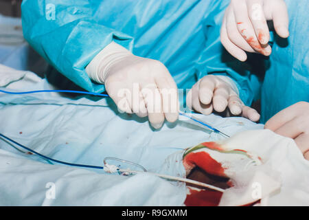 open heart surgery Heart surgery in operating room Stock Photo ...