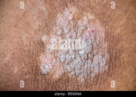 Close-up of psoriasis patches on the lower back of a person wearing ...