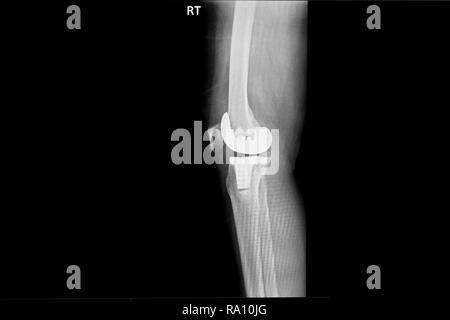 Total knee replacement. Lateral X-ray of the components of a prosthetic ...
