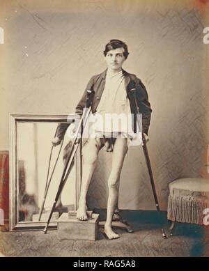 Gunshot Fracture of the Shaft of the Right Femur, United with Great ...