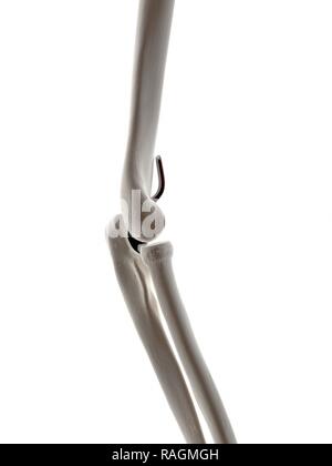 Illustration of an elbow implant Stock Photo - Alamy