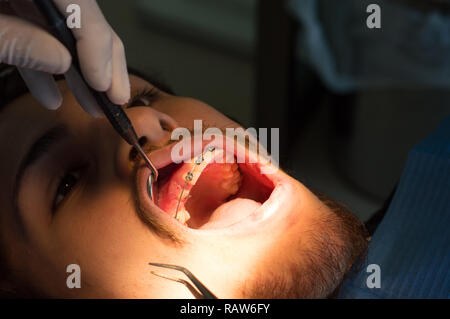 Orthodontics Procedure. Exposure of unerupted, impacted tooth Stock ...