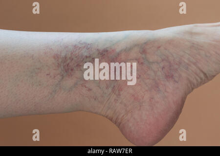 Varicose veins closeup, foot on modular bath step, image isolated on ...