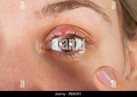 Close up picture of upper eyelid inflammation - chalazion - young ...