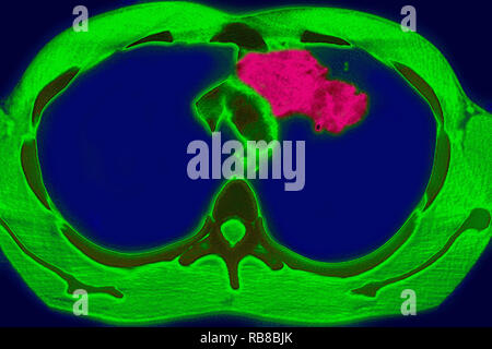 PULMONARY TUBERCULOSIS, CT-SCAN Stock Photo - Alamy