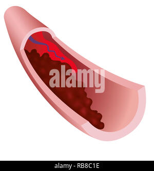 ARTERIAL THROMBOSIS, DRAWING Stock Photo - Alamy