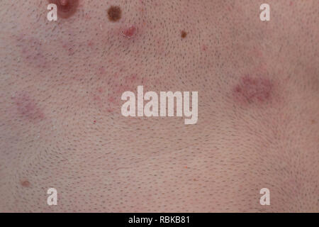 Shingles, Zoster or Herpes Zoster symptoms on arm Stock Photo - Alamy