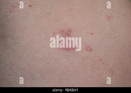 Shingles, Zoster or Herpes Zoster symptoms on arm Stock Photo - Alamy