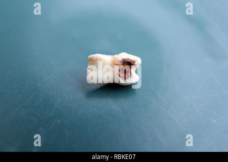 extracted tooth with cavity and caries Stock Photo - Alamy