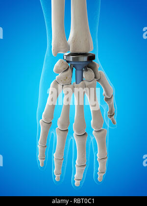 Orthopedic surgical plate and screw implant Stock Photo: 181110353 - Alamy
