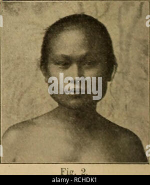 Java Man or Pithecanthropus erectus (Homo Erectus erectus). Early human ...