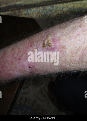Skin Merkel cell cancer on arm and head of male patient Stock Photo - Alamy