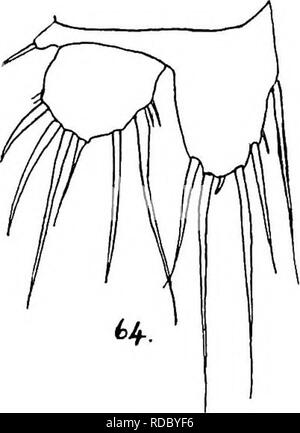 Unequal length of legs in a 63 year old female patient, due to slipped ...
