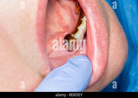 Patient with bad metal dental crowns close-up. The concept of treatment ...