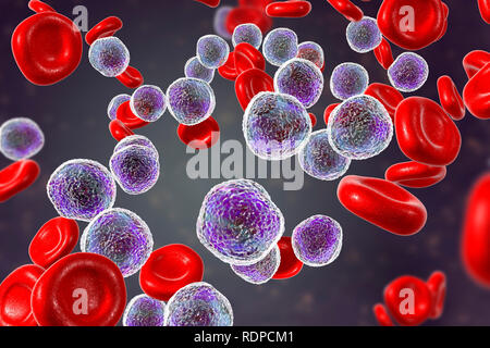 Acute lymphoblastic leukaemia bone marrow smear. Computer illustration ...