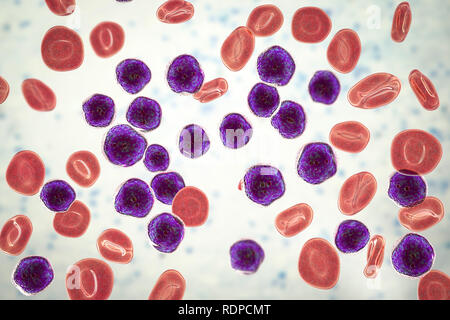 Acute lymphoblastic leukaemia bone marrow smear. Computer illustration ...