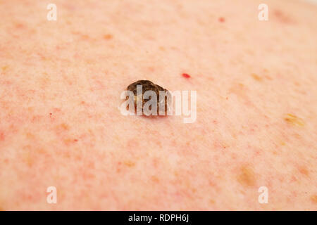 Seborrheic keratosis. Close-up of a seborrheic keratosis (seborrheic or ...
