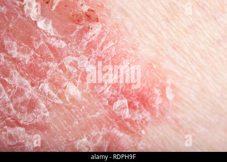 Psoriasis health condition red patches on skin back Stock Photo - Alamy