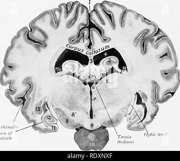 Posterior Commissure Coronal