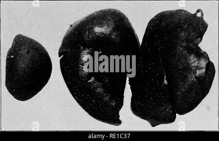 Liver: miliary tuberculosis Stock Photo - Alamy