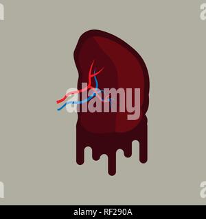 Medical illustration of diseases of the spleen, abscess, cysts, rupture ...