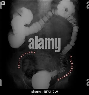 Abdomen x-ray of a barium contrast examination showing diverticulosis ...