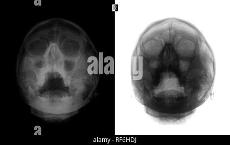 Radiography of a human skull paranasal sinuses rhinosinusitis ...