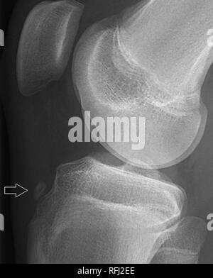 Avulsion fracture of tibial tuberosity, annotated Stock Photo - Alamy