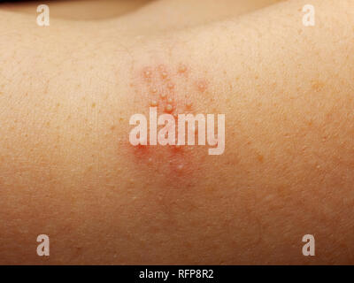 Close up of girl has rash and other nonspecific skin eruption on her ...