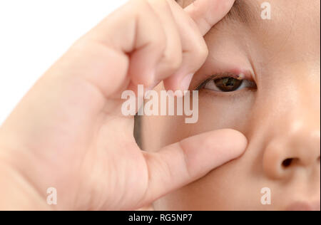 Meibomian abscess. Close-up of a meibomian abscess on the lower eyelid ...