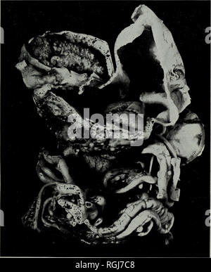 Liver: miliary tuberculosis Stock Photo - Alamy