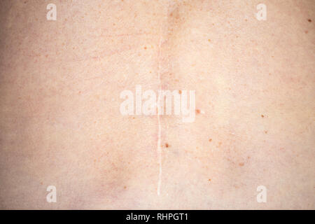 Scar on the back of an old caucasian woman after a spinal stenosis ...