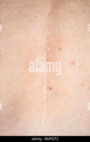 Scar on the back of a woman after the stitches have been removed Stock ...