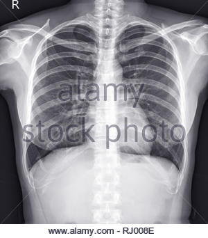 Chest x-ray of a 3 year old female baby with signs of pneumonia in ...
