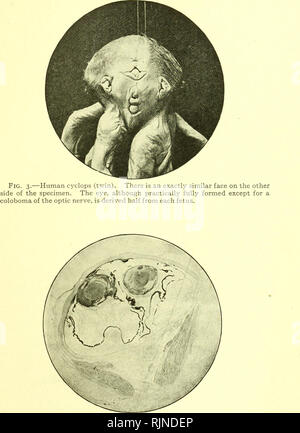 Cyclopia human Stock Photo - Alamy