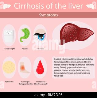 Symptoms of Infectious mononucleosis. Vector illustration infographics Stock Vector Image & Art ...