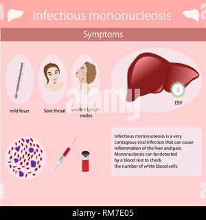 Symptoms of Infectious Mononucleosis disease Stock Vector Image & Art - Alamy