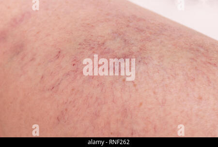 Footprint on the skin from vascular dilatation of veins, vascular ...