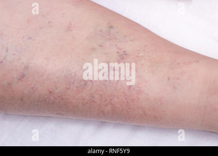 Vascular marks on the skin from varicose veins, vascular pattern on the ...