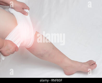 Treatment of bursitis of the knee joint with a medical compress, close ...