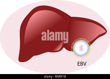 Symptoms of Infectious mononucleosis. Vector illustration infographics Stock Vector Image & Art ...