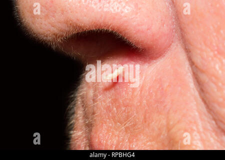 Inflamed sebaceous gland with sebum Stock Photo - Alamy